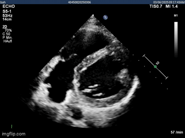 Parasternale kurze Achse (PSAX) – Radiologietechnologie Wiki